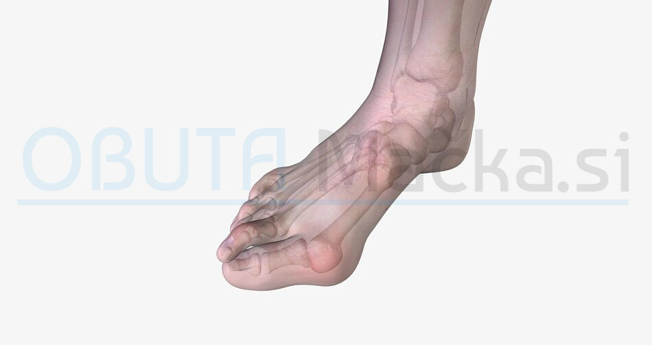 Hallux Valgus – Deformacija nožnega palca / Obutamacka.si - Spletna ...